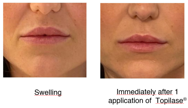 SoftFil® Topilase®: Everything you need to know about the topical dermo ...