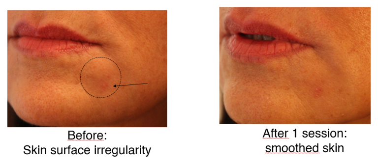 SoftFil® Topilase®: Everything you need to know about the topical dermo ...