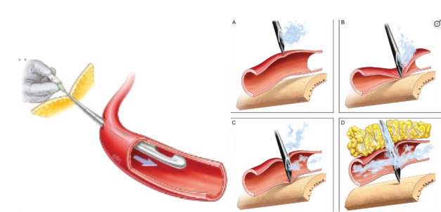 How to inject safely with SoftFil® microcannula ? | SoftFil®